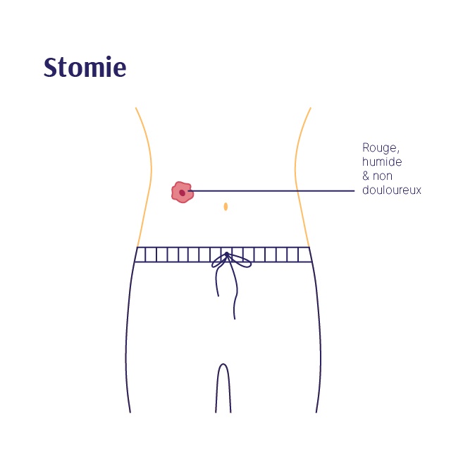 Conseils Pour Garder Une Peau Saine Avec Ma Stomie